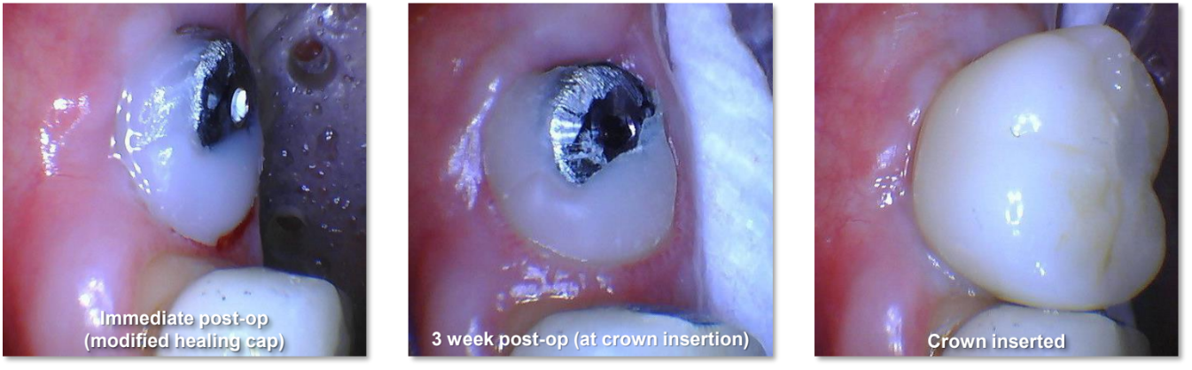 Tissue Recontouring for Implant Restoration 2