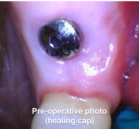 Tissue Recontouring for Implant Restoration