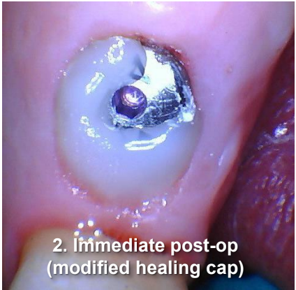 Tissue Recontouring for Implant Restoration