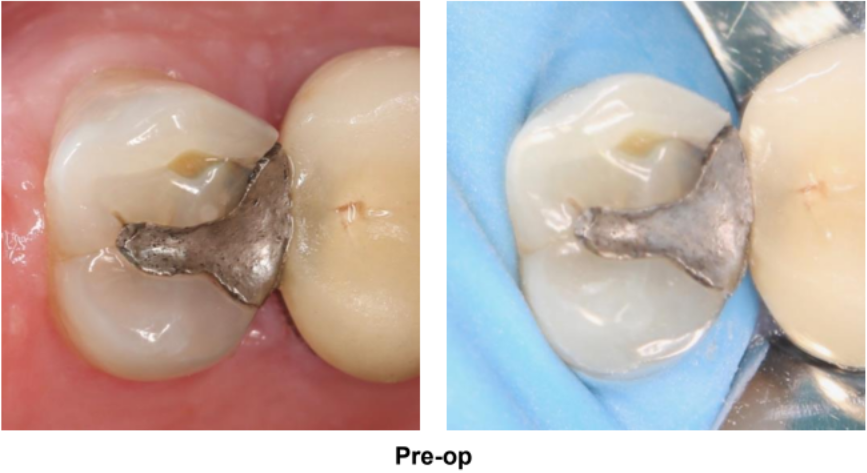 Deep Class II Restoration on Tooth #12 DO