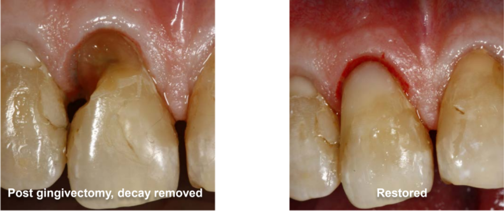 Gingivectomy and Restoration on Tooth #8