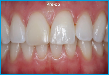 Class IV (Esthetic Composite Removal)