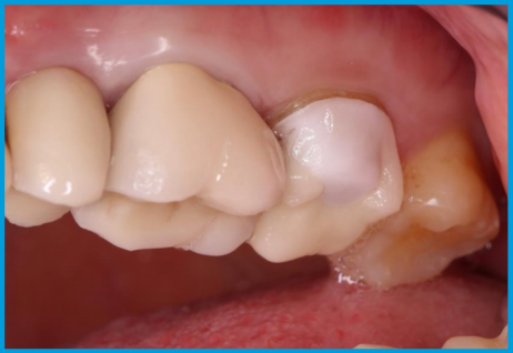 Porcelain Fused to Zirconia Crown Removal