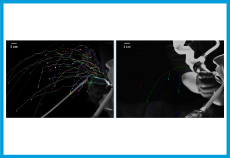 Computational Tracking of Dental Splatter