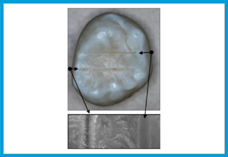 9.3µm Laser: Pulpal Safety during Ablation of Tooth Occlusal Surfaces